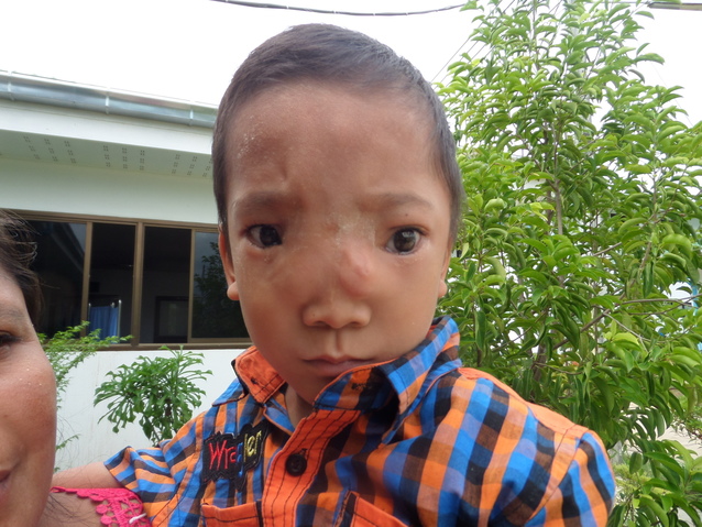 Pyae Phyo from Burma raised $1,500 to fund corrective surgery. | Watsi