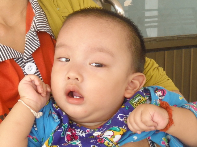 Thu Rain from Burma raised $1,500 to fund head surgery. | Watsi