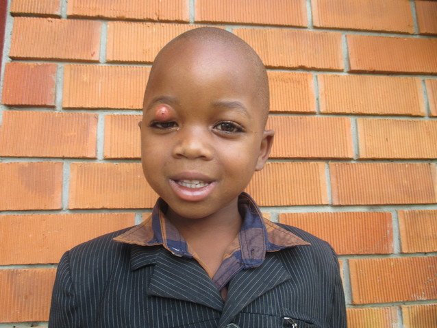 Success! Segawa from Uganda raised $187 to fund a mass removal ...