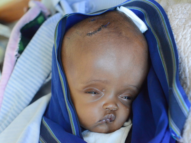 Success! Monicah from Kenya raised $685 to fund brain surgery. | Watsi