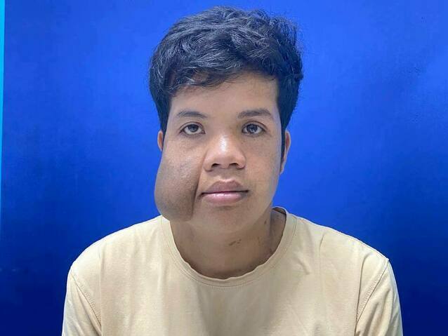 Success! Seng Leng from Cambodia raised $726 to fund tumor removal ...