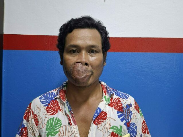 Success! Sipha from Cambodia raised $651 to fund mass removal surgery ...