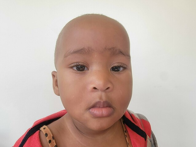 Success! Dinnah from Tanzania raised $341 to fund clubfoot treatment ...