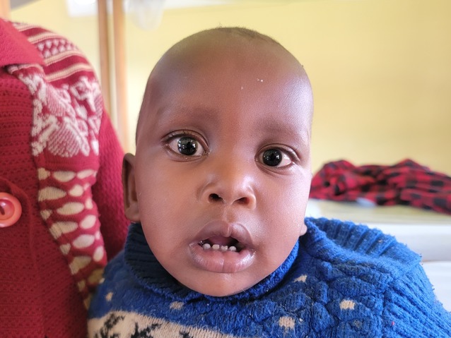 Success! Meshack from Tanzania raised $341 to fund clubfoot treatment ...