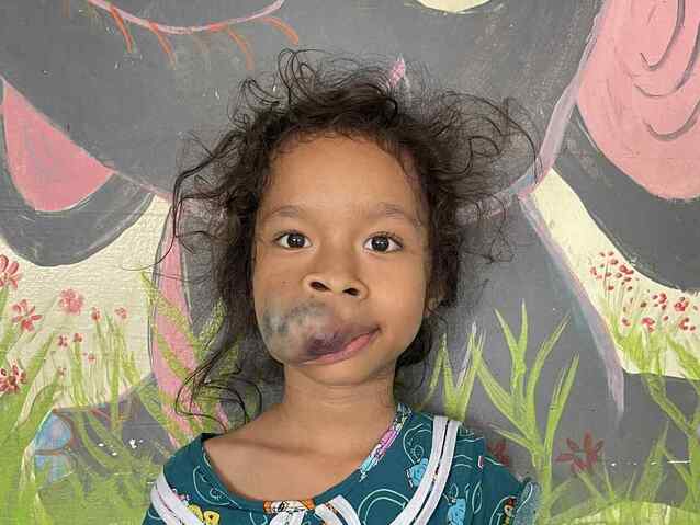 Success! Ariya from Cambodia raised $841 to fund surgery to remove a ...