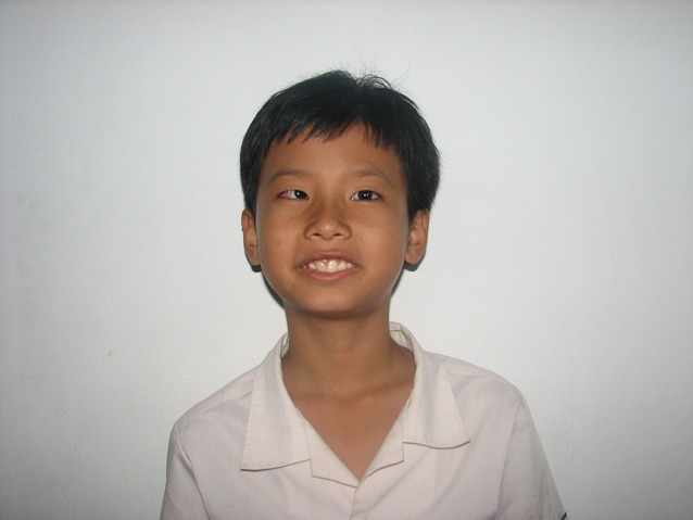 Vibol from Cambodia raised $290 to correct the misalignment of his ...