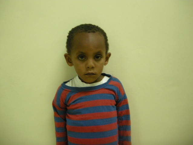 Rabira from Ethiopia raised $1,500 to treat anorectal malformation. | Watsi