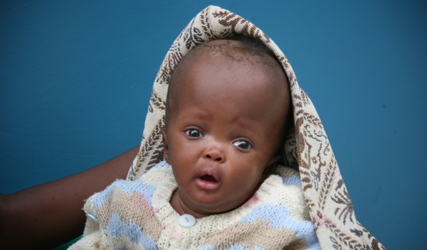 Success! Faour from Kenya raised $615 to drain excess fluid from her ...