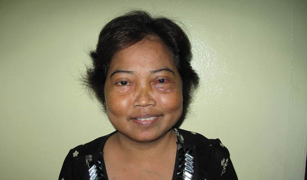 Success! Sothy from Cambodia raised $225 for vision-restoring cataract surgery. | Watsi