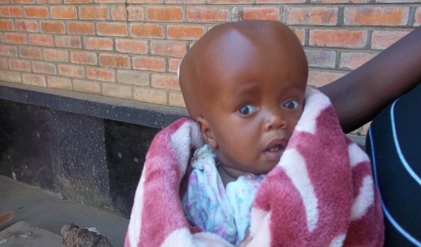 Success! Akimu from Malawi raised $992 to treat hydrocephalus. | Watsi