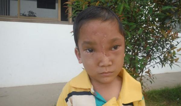 Pyae Phyo from Burma raised $1,500 to fund corrective surgery. | Watsi