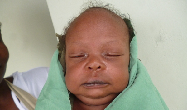 Success! Saitoti from Tanzania raised $1,200 to fund spinal surgery ...