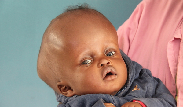 Success! Nimrod from Kenya raised $685 to fund brain surgery. | Watsi