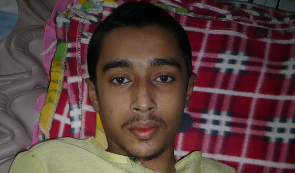 Success! Aung from Burma raised $851 to fund rotation flap surgery. | Watsi