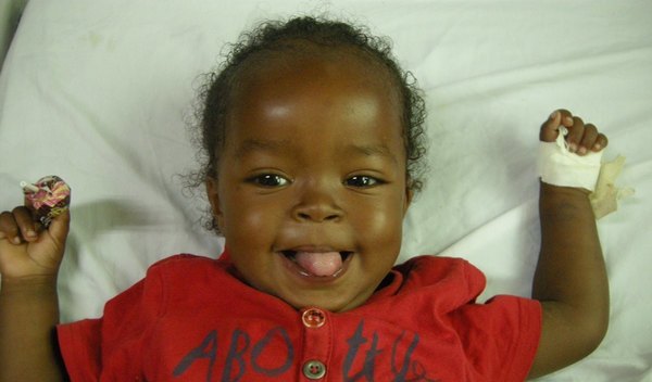 Success! Gudise from Ethiopia raised $1,500 to fund corrective surgery ...