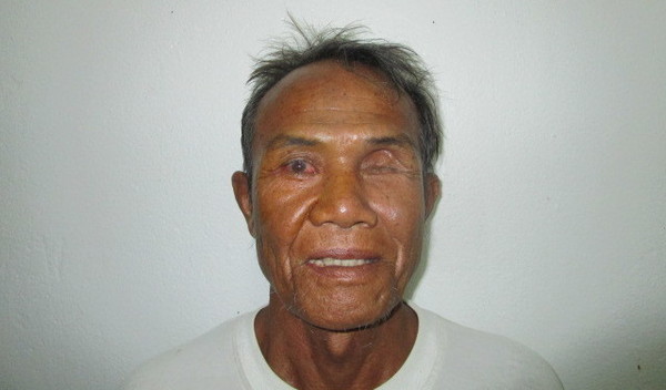 Success! Heang from Cambodia raised $229 to fund cataract eye surgery ...