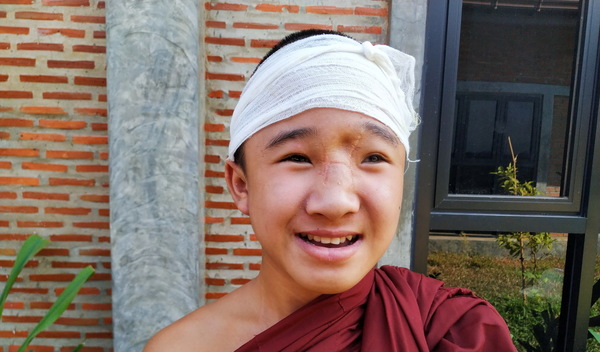 Success! Aung from Burma raised $1,500 to fund a hydrocephalus shunt ...