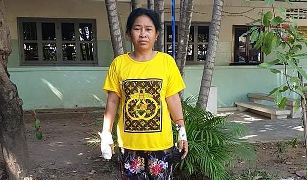 Success! Sam Oeun from Cambodia raised $231 to fund surgery to remove a mass on her hand. | Watsi