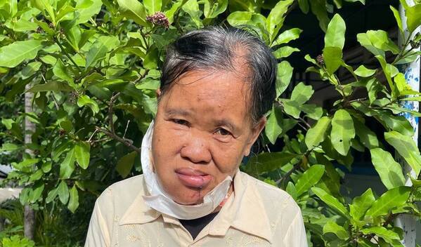 Success! Sokkea from Cambodia raised $741 to fund mass removal surgery. | Watsi