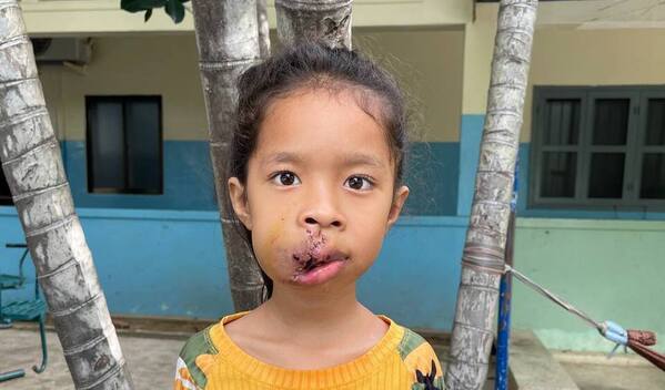 Success! Ariya from Cambodia raised $841 to fund surgery to remove a ...