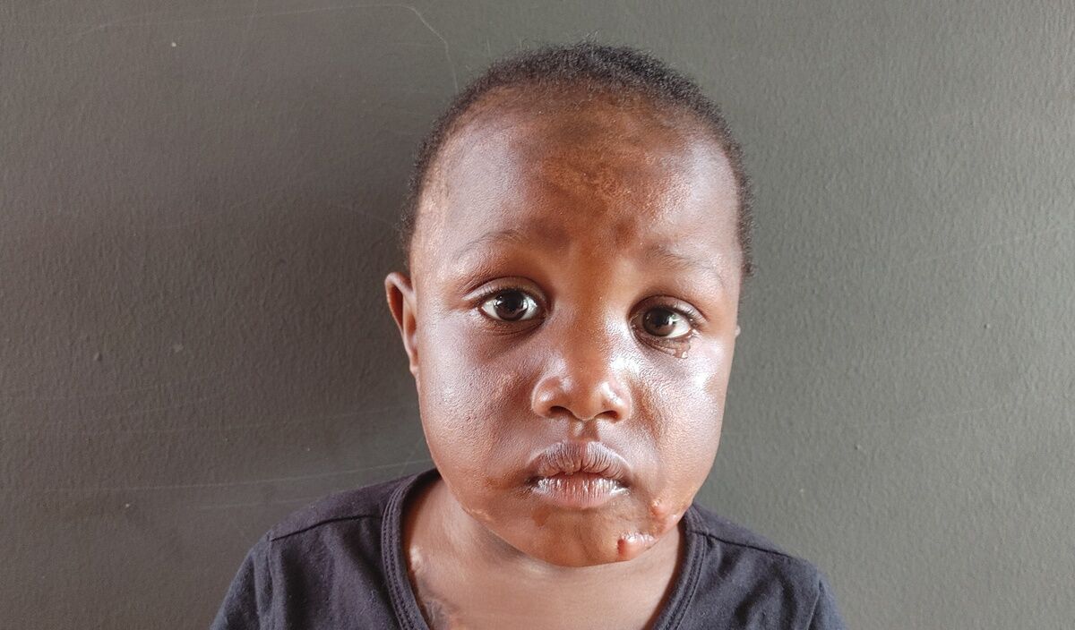 Success! Elsa from Tanzania raised $832 to fund burn contracture ...