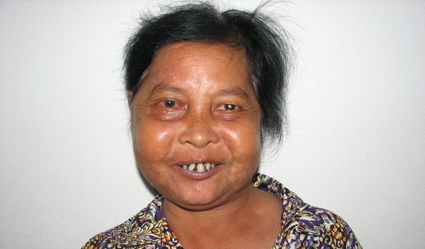 Sarim from Cambodia raised $150 so she can see again. | Watsi